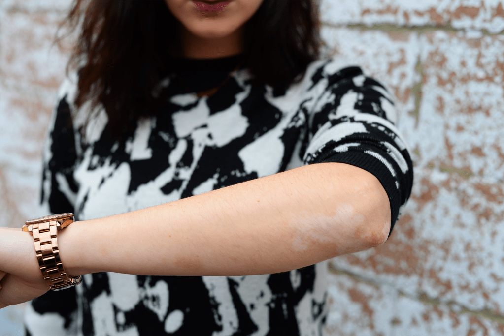 On ose les motifs léopards et à taches avec du vitiligo